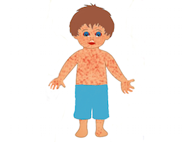 Epidémie de rougeole en Nouvelle-Aquitaine et en France, les signes de ...